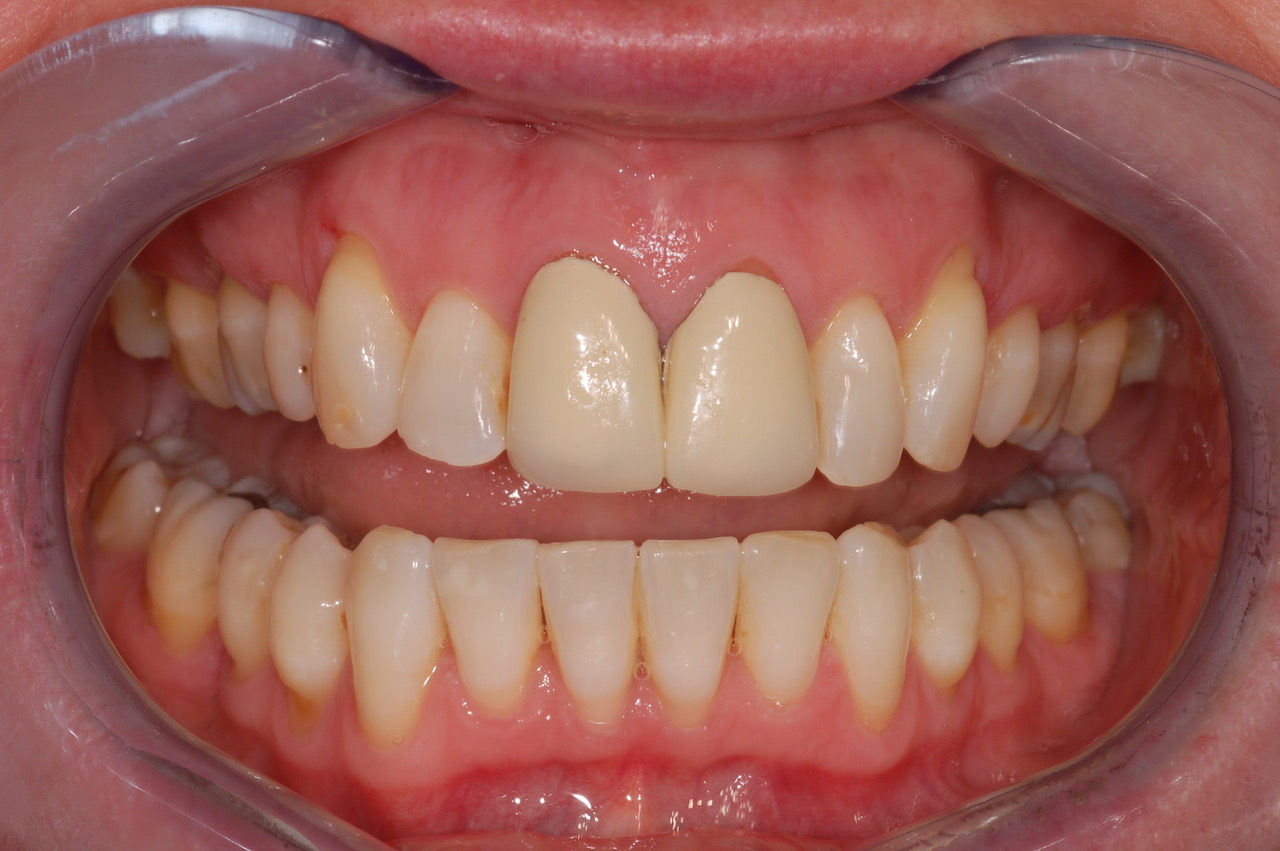 BACD Foundation Dentist Case Submission 2025 - BACD